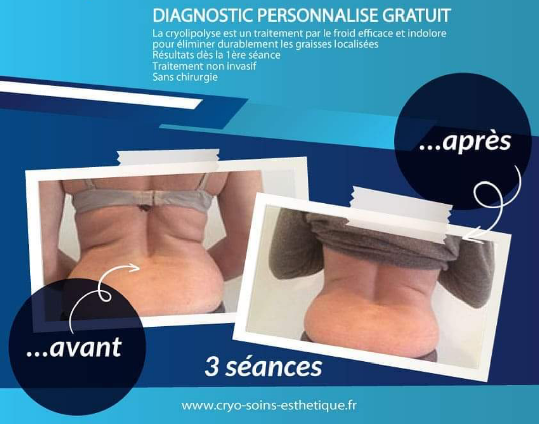 La cryolipolyse valence - Cryo Soins Esthetique